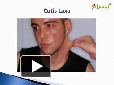 Cutis Laxa: Causes, Symptoms, Diagnosis and Treatment presentation ...