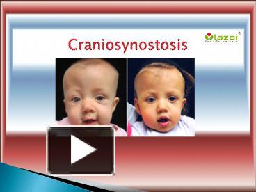 Craniosynostosis: Types, Causes, Symptoms, Diagnosis and Treatment ...