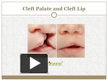 Cleft Palate and Cleft Lip: Symptoms, Causes, Diagnosis and Treatment ...
