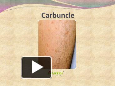 Carbuncle: Causes, Symptoms, Diagnosis, Treatment and Prevention ...