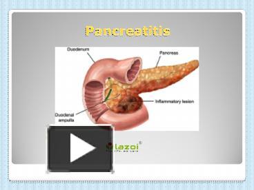 Pancreatitis : Overview, Symptoms, Types, Causes, Diagnosis and ...