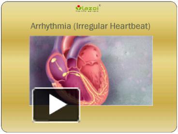 Arrhythmia (Irregular Heartbeat): Symptoms, Causes, Diagnosis and ...