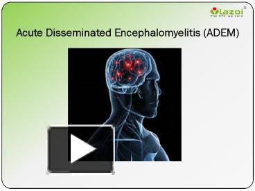 Acute disseminated encephalomyelitis (ADEM): Symptoms, causes ...