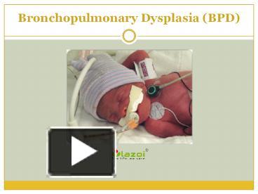 Bronchopulmonary dysplasia (BPD) in infants presentation | free to download