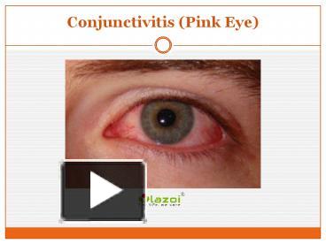 Conjunctivitis (Pink Eye): Symptoms, Causes, Treatment and more ...