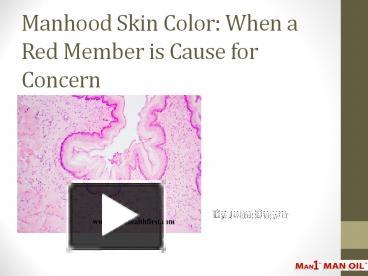 PPT – Manhood Skin Color: When a Red Member is Cause for Concern ...