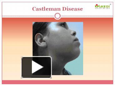 Castleman Disease: An overview of symptoms, diagnoses and treatment ...
