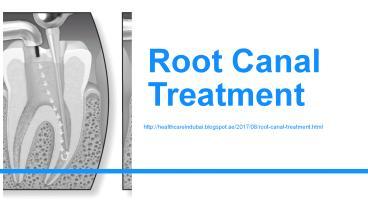 Root Canal Treatment presentation | free to download