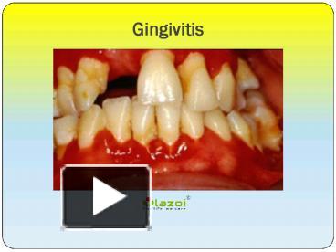 Gingivitis: Symptoms, Causes, Diagnosis and Treatment presentation ...