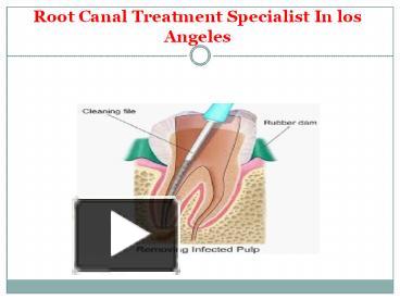 PPT – Root Canal Treatment Specialist In los Angeles PowerPoint ...
