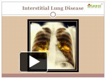 Interstitial Lung Disease: Causes, symptoms, diagnosis and treatment ...