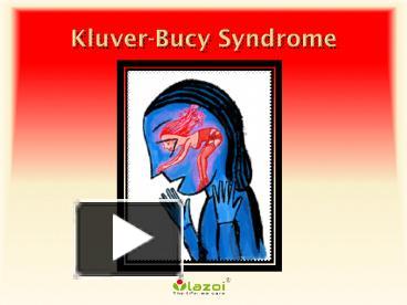 Kluver-Bucy Syndrome: Very rare behavioural disorder presentation ...