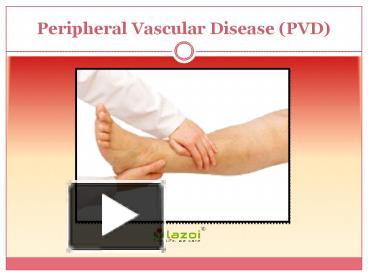 Peripheral Vascular Disease (PVD) - Causes, Symptoms, Diagnosis and ...