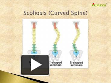 PPT – Scoliosis (Curved Spine): Symptoms, types, diagnosis and ...