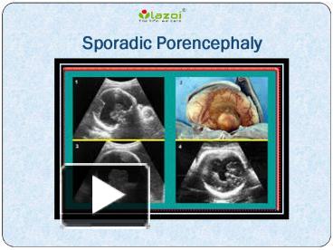 Sporadic Porencephaly: Symptoms, causes, diagnosis and treatment ...