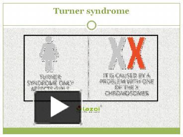 Turner syndrome: Symptoms, Causes, Treatment of Turner syndrome ...