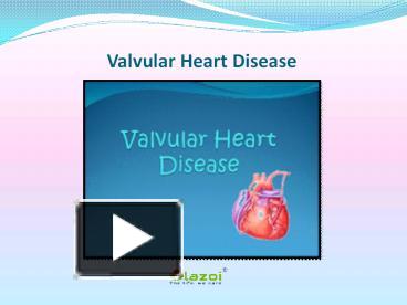 Valvular Heart Disease: Symptoms, Causes, Diagnosis and Treatment ...
