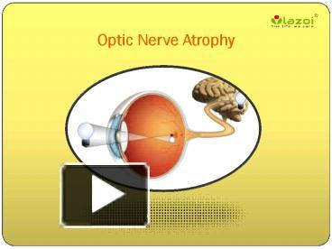 Optic Nerve Atrophy: A guide to symptoms, causes and treatment ...