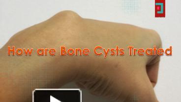 PPT – How are Bone Cysts Treated? PowerPoint presentation | free to ...