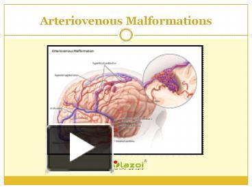 PPT – Arteriovenous Malformations Causes, Symptoms, Diagnosis, Risk ...