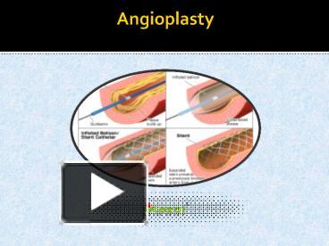 Angioplasty : Treatment, Cost, Side Effect, Procedure and Affordable ...