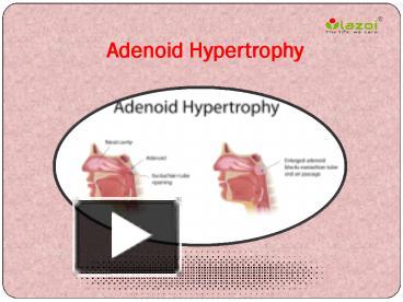 Adenoid hypertrophy Causes, Symptoms, Diagnosis, Prevention Treatment ...