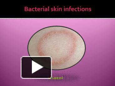Bacterial skin infections : Causes, Symptoms, Treatment and Diagnosis ...