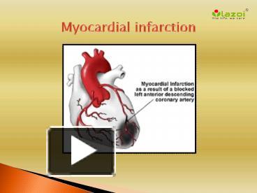 Myocardial infarction : Overview, Causes, Symptoms, treatment and ...
