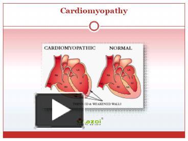 Cardiomyopathy : Causes, Symptoms,Types, Diagnosis and Treatment (1 ...