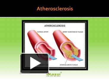 PPT – Atherosclerosis : Causes, symptoms, diagnosis and treatment ...