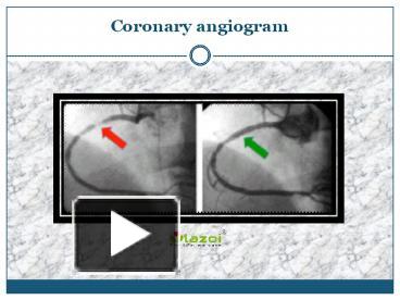coronary angiogram presentation | free to download