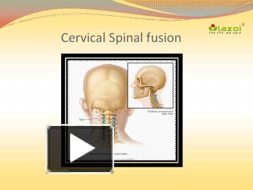 Cervical Spinal fusion presentation | free to download