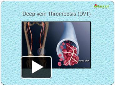 Deep vein Thrombosis (DVT) (1) presentation | free to download