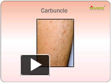 PPT – Carbuncle: Causes, Symptoms, Diagnosis, Treatment and Prevention ...