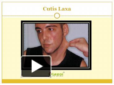 Cutis Laxa: Causes, Symptoms, Diagnosis and Treatment (1) presentation ...