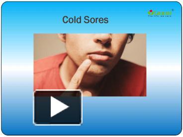 Cold Sores: Symptoms, Causes, Diagnosis and Treatment (1) presentation ...