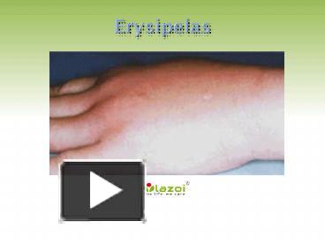 PPT – Erysipelas: Symptoms, Causes, Diagnosis and Treatment (1 ...