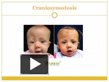 Craniosynostosis: Types, Causes, Symptoms, Diagnosis and Treatment (1 ...
