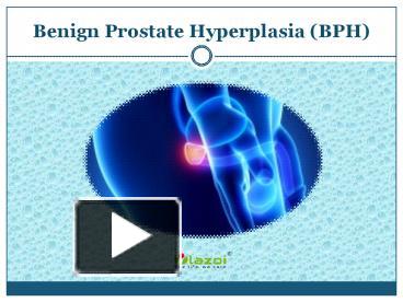 BPH (Benign Prostate Hyperplasia): Causes, Symptoms, and Treatment (1 ...