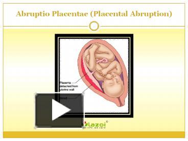 Abruptio Placentae (Placental Abruption): Overview of symptoms, causes ...