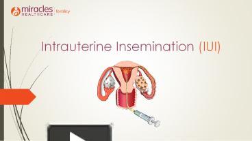 Intrauterine insemination (IUI) presentation | free to download