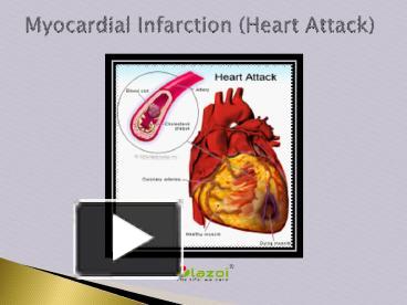 Myocardial Infarction (Heart Attack): Symptoms, Causes, Risk Factors ...
