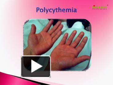 Polycythemia: Causes, Symptoms and Treatment (1) presentation | free to ...