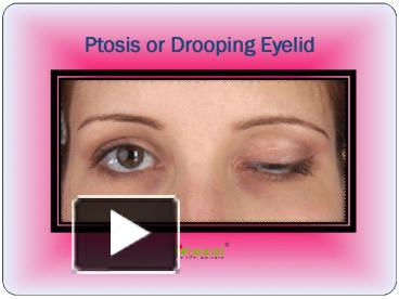 Ptosis or Drooping Eyelid: Symptoms, causes, diagnosis and treatment (1 ...