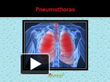 Pneumothorax: Symptoms, causes, diagnoses and treatment (1 ...