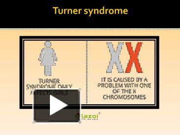 Turner syndrome: Symptoms, Causes, Treatment of Turner syndrome (1 ...