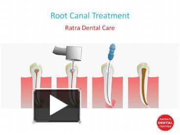 PPT – Root Canal Treatment PowerPoint presentation | free to download ...