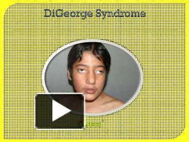 DiGeorge Syndrome presentation | free to download