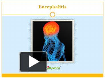 Encephalitis presentation | free to download