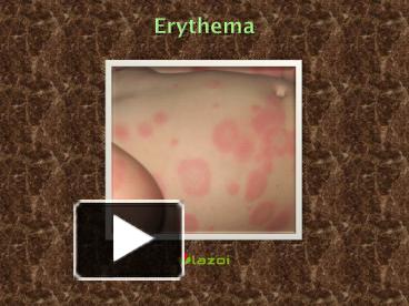 Erythema presentation | free to download